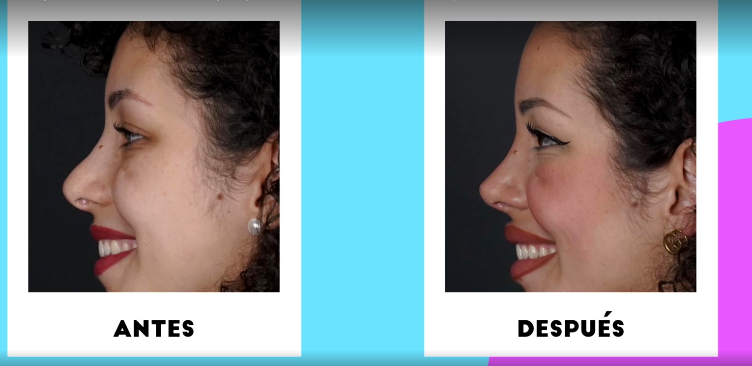 Así era antes Bayan de su rinoplastia. Antes y Después | La isla de las ...